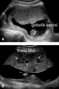 Mol Gebelik (Üzüm Gebeliği) - Op. Dr. Cüneyt Özcan